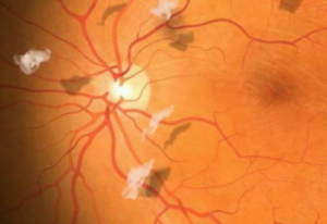 Moscas Volantes no olho: causas, sintomas e tratamentos